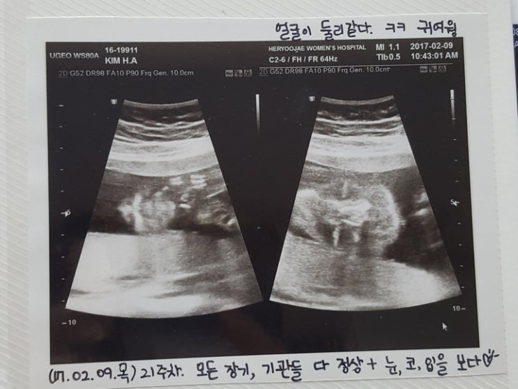 임신 17~21주첫 태동 정밀초음파 눈 코 입 확인 네이버 블로그