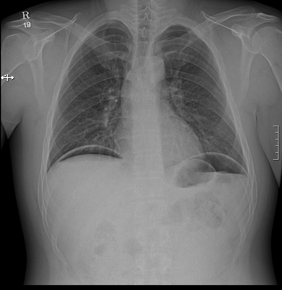 GS case - duodenal ulcer perforation, Chest PA free air [외과 파견] : 네이버 블로그