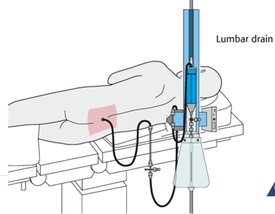 Lumbar drainage : 네이버 블로그