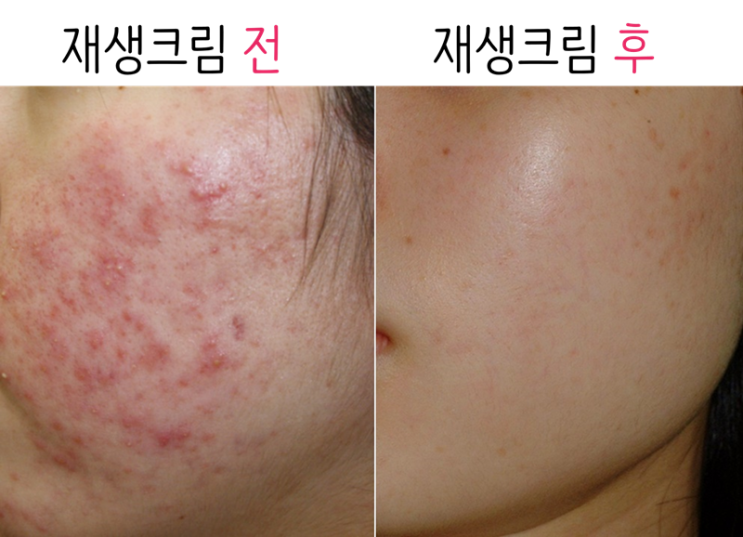 여드름 흉터 연고 And 여드름 흔적크림 노답 여드름자국 재생크림 후기 네이버 블로그