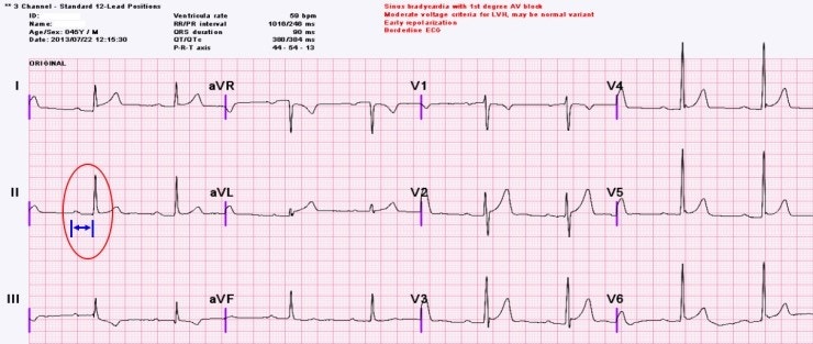 심장 리듬 IV. 방실차단(AV block) : 네이버 블로그