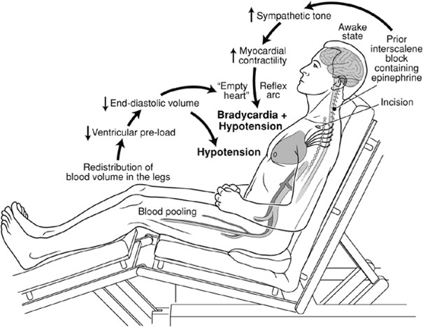 [마취] interscalene BPB후 sitting (beach-chair) position_shoulder ...