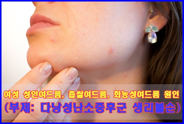 여성 성인여드름 좁쌀여드름 화농성여드름 원인★부제 다낭성난소증후군 생리불순 네이버 블로그