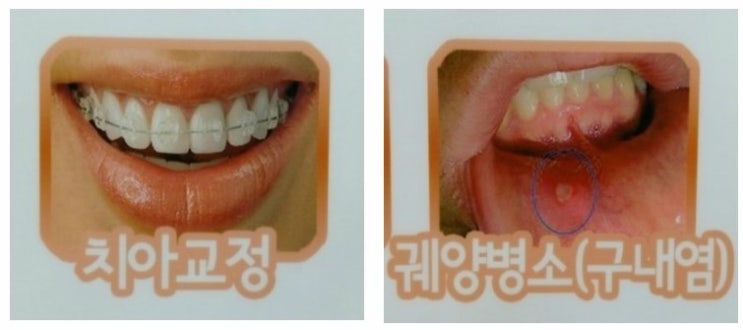 [청라 교정] 천연성분 구강 상처치료제 "파르겔(PHARGEL)" : 네이버 블로그
