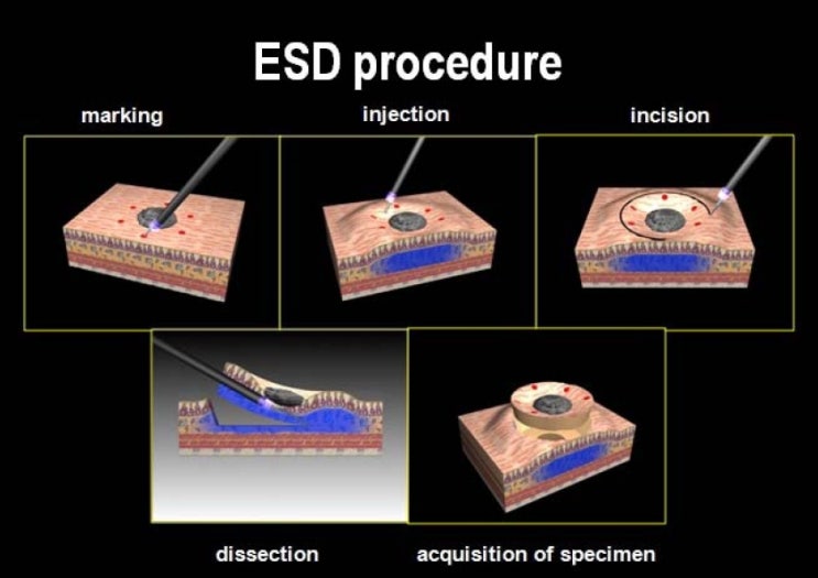 내시경 치료 , EMR & ESD, 내시경 전 아스피린 복용여부 : 네이버 블로그