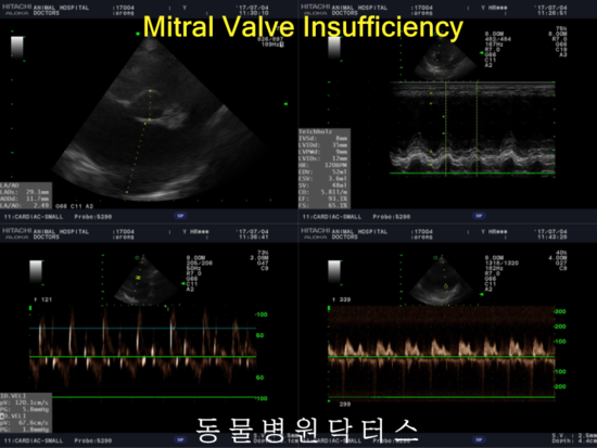 이첨판폐쇄부전 승모판폐쇄부전 MVI Mitral Valve Insufficiency STAGE C2 : 네이버 블로그