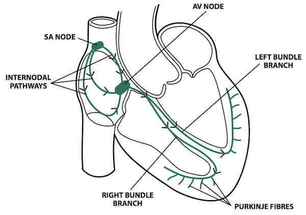 PVC 심실조기수축 premature ventricular contraction : 네이버 블로그