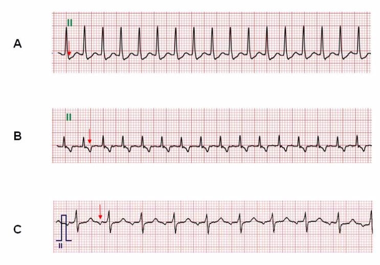 Short RP vs. long RP tachycardia : 네이버 블로그