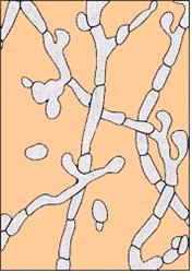 모닐리아(칸디다) 외음질염 Monilial vulvovaginitis : 네이버 블로그