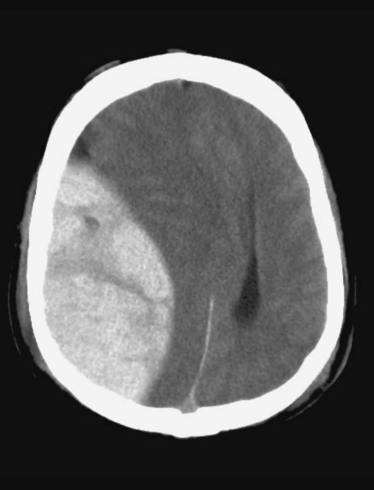 뇌 혈관질환, 두개내출혈, edh, sdh, sah 수술 : 네이버 블로그
