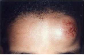 두피 좌상(頭皮挫傷) Scalp contusion : 네이버 블로그