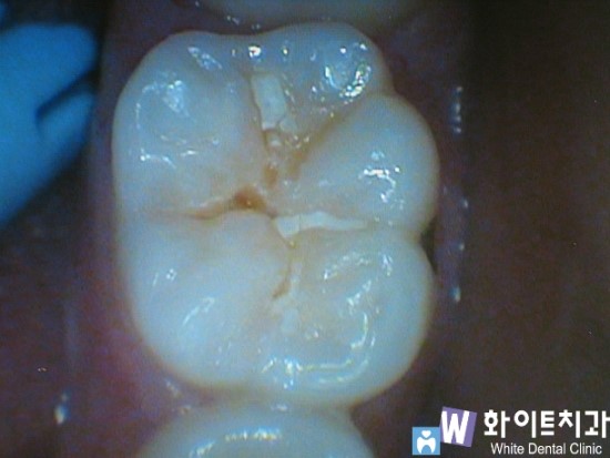 소아 어린이청소년 영구치충치치료 레진세라믹인레이치료 7009 네이버 블로그