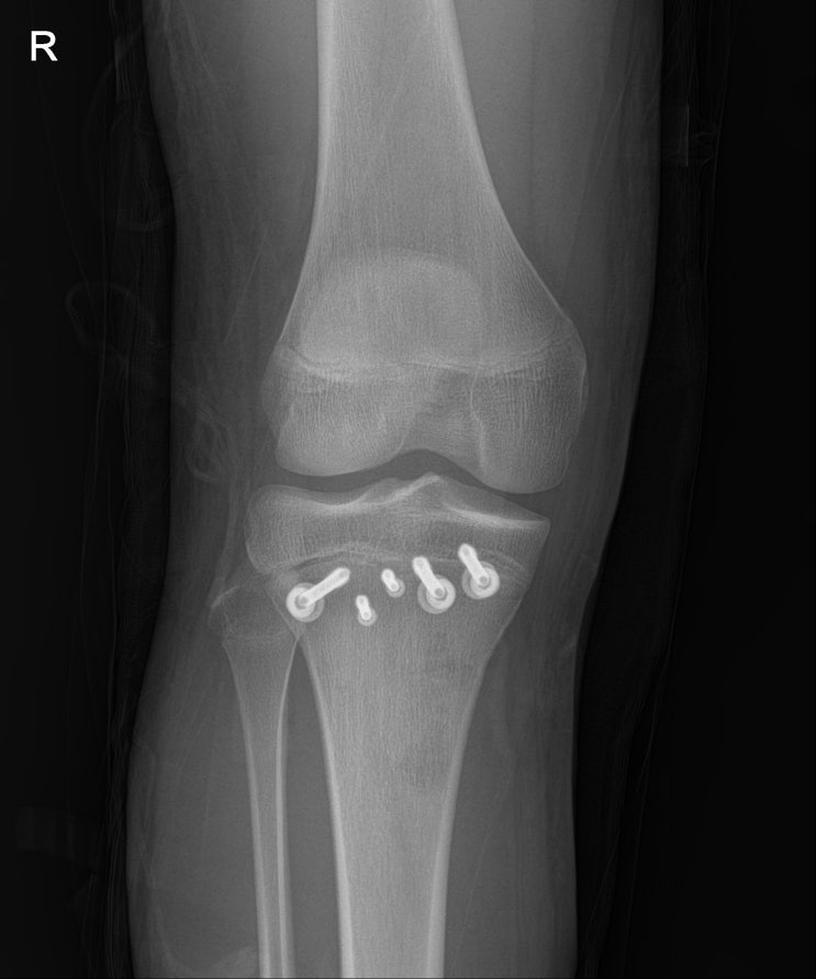 청소년의 근위 경골의 성장판 골절에서의 관혈적 정복술 및 내고정술orif At Growth Plate Fracture Of