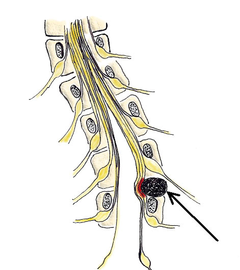 Antalgic posture, 통증회피자세 : 네이버 블로그