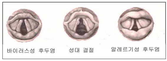 급성 경련성 크루프(급성 경련성 후두염) Acute spasmodic croup (Acute spasmodic ...