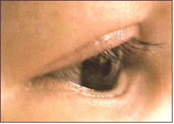 첨모난생 Trichiasis : 네이버 블로그