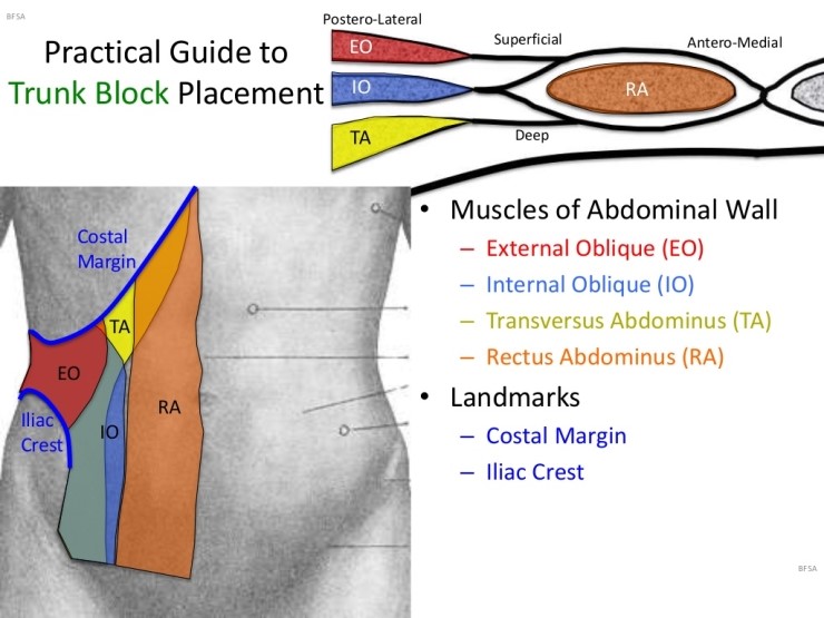 Transversus Abdominis plane block [초음파] : 네이버 블로그