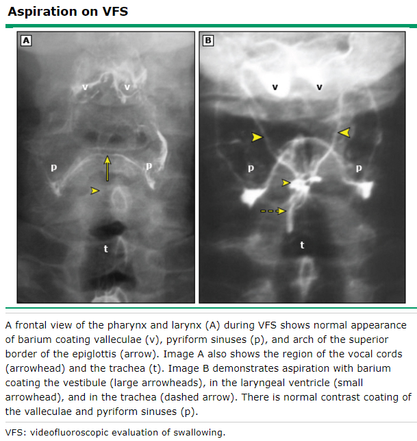 Videofluoroscopic swallow study (VFSS)와 barium swallow : 네이버 블로그