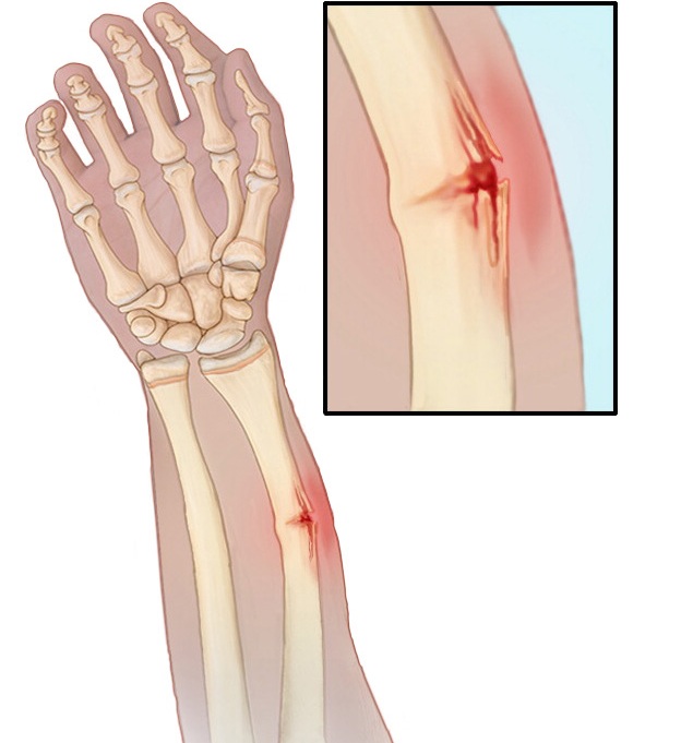 융기골절 (Torus fracture, Buckle fracture) : 네이버 블로그