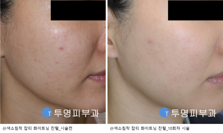 색소침착 잡티 화이트닝 잔털제거 30대 여성10회차 시술 역삼역 피부과 투명피부과 네이버 블로그