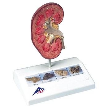 신장결석모형,Kidney Stone Model(K29) : 네이버 블로그