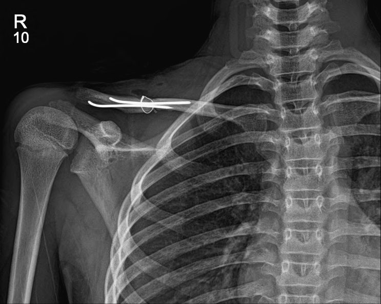 소아의 쇄골 골절에서의 골수강내 핀고정술(intramedullary pin fixation at children`s ...