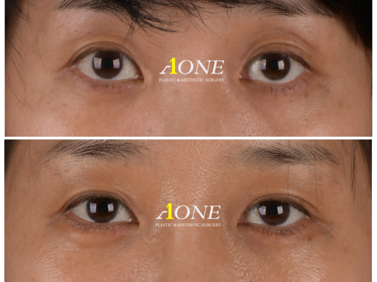 삼백안 교정_The Correction of Sanpaku Eyes(Scleral Show) : 네이버 블로그