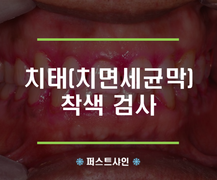 구강건강 치태치면세균막 착색 검사의 중요성 네이버 블로그