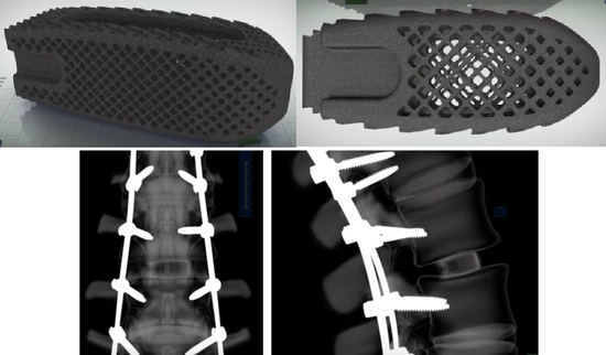 3D Printed Cellular Titanium Spinal Implants : 네이버 블로그
