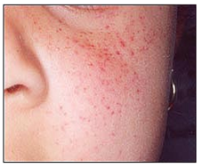 신생아의 머리, 얼굴 등에 생긴 점상출혈 Petechiae in the face and the head of newborn ...