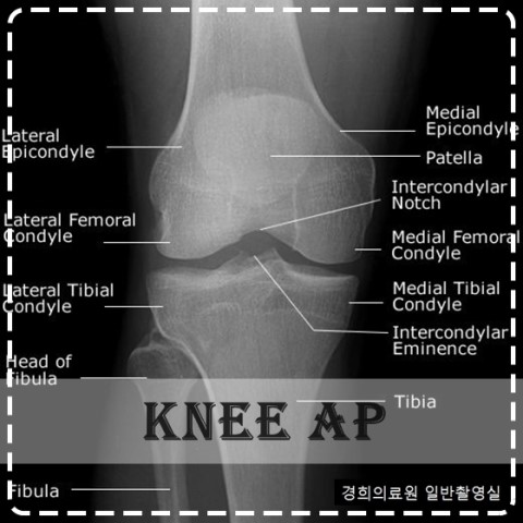 Knee AP : 네이버 블로그