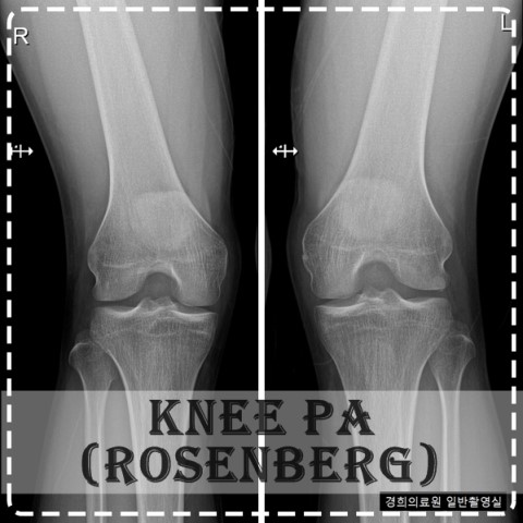 Knee PA(Rosenburg) : 네이버 블로그