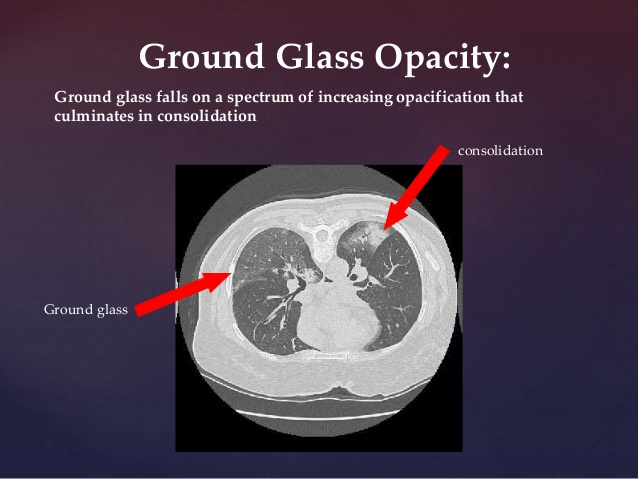 GGO(Ground Glass Opacity) vs Consolidation : 네이버 블로그