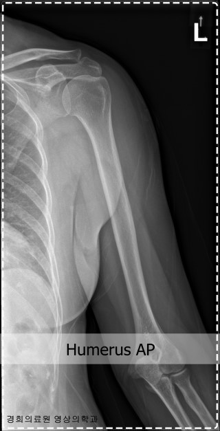 Humerus AP : 네이버 블로그