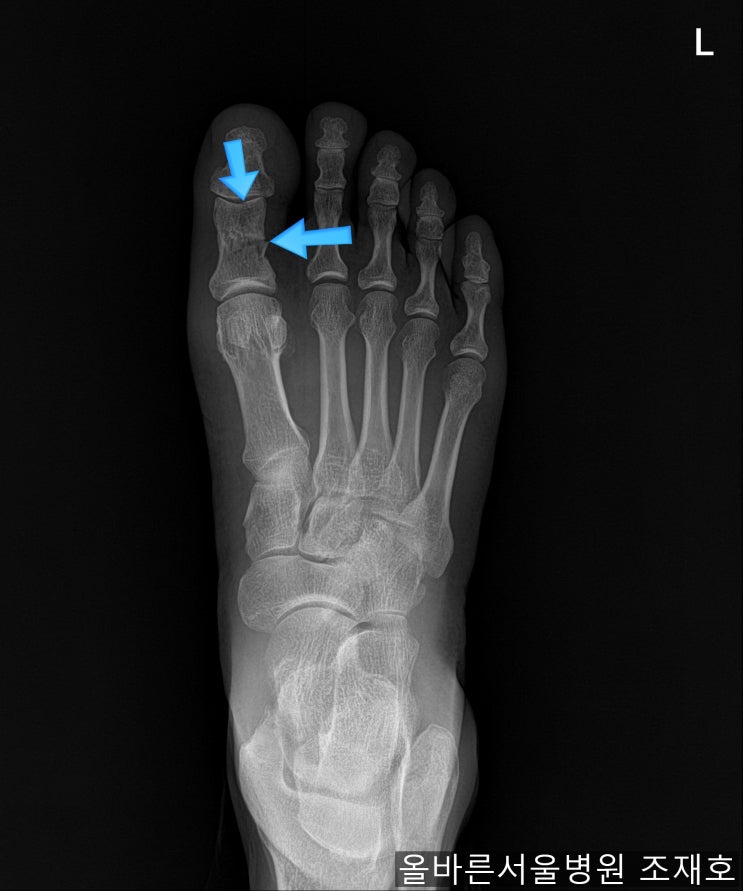 엄지 발가락의 관절내 분쇄 골절에서의 고정술(ORIF at big toe intraarticular comminuted ...