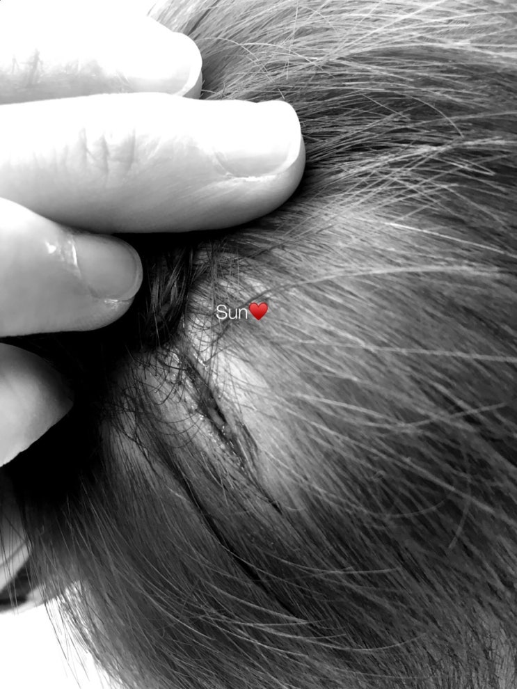 아기 유아 두피 열상 아기머리찢어짐 최근사진 새로첨부ㅡ블로그 쓴 17년 9월기준 회복과정 네이버 블로그