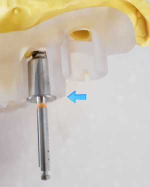 서울순치과 이호정 원가이드를 이용한 상악동 거상술 (ONE CAS KIT출시이전의 방법) : 네이버 블로그
