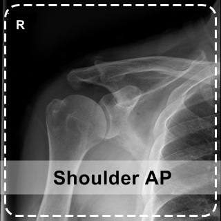 Shoulder AP : 네이버 블로그