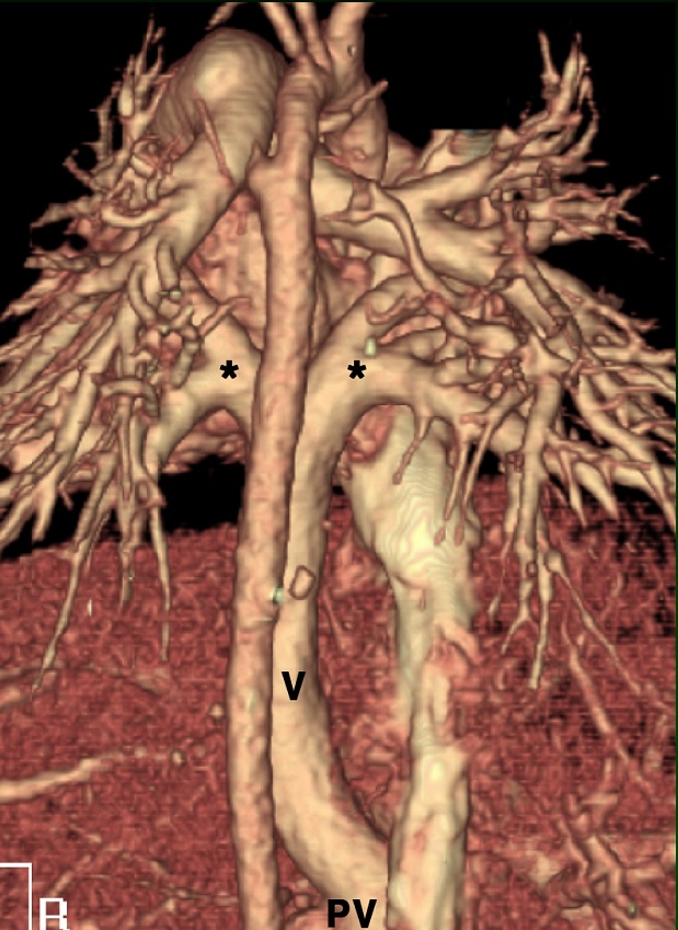전 폐정맥 환류이상(TAPVR) / 부분 폐정맥 환류이상(PAPVR) / 선천성 심장질환 / 너른생각 : 네이버 블로그