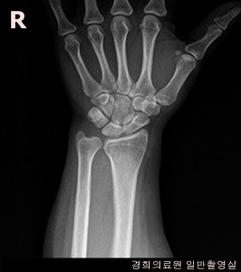 Wrist AP (cephalad 12°) : 네이버 블로그