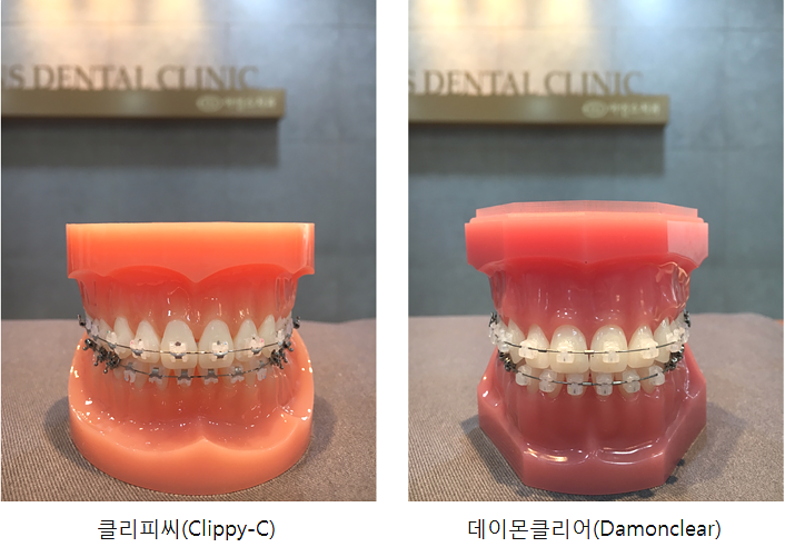 장안동 아인스치과 - 교정브라켓 클리피씨(Clippy-c) , 데이몬클리어(Damon clear) : 네이버 블로그
