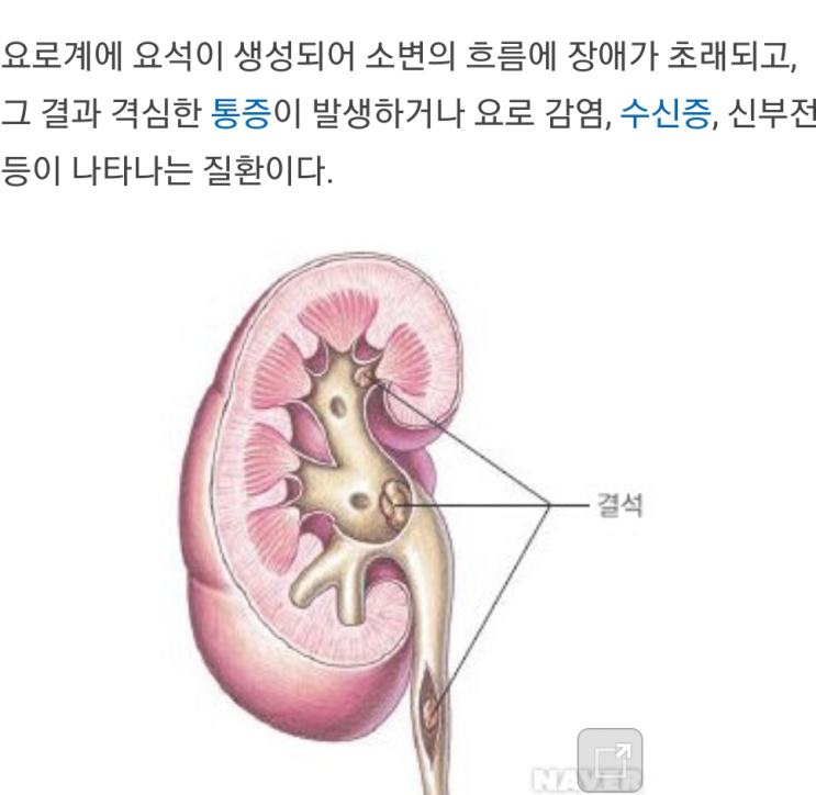요로결석 체외충격파쇄석술 수술비지급건 네이버 블로그