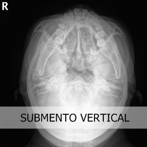 Submento-Vertical : 네이버 블로그