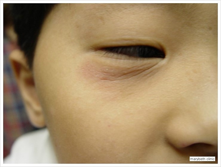 한국에 흔한 피부질환 [개정판] - 제7장. 아토피피부염 - 진단: 데니-모르간 주름(Dennie-Morgan fold ...