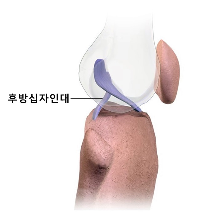 후방십자인대 파열의 보존적 치료 청주 정형외과 네이버 블로그
