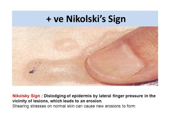 [피부외과학] 염증성 피부병(발진)의 주요 용어 : 네이버 블로그