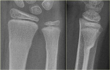 융기 골절(Torus fracture, Buckle fracture) : 네이버 블로그