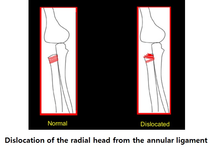 주내장(Pulled elbow, Nursemaid's elbow) : 엄마가 아이 팔을 잡아 끌다가 팔이 빠졌어요 : 네이버 블로그