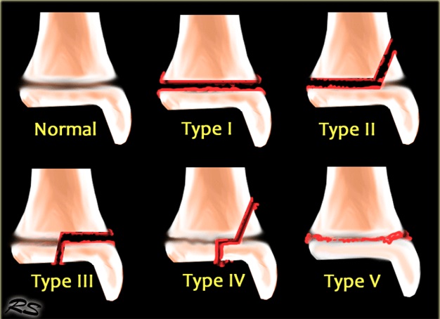골단판 손상(Physeal injury)의 분류(Salter-Harris classification) : 네이버 블로그