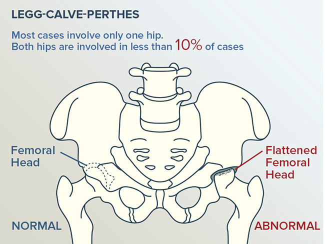 소아 대퇴골두 무혈성 괴사(Legg-Calve-Perthes disease : LCP) : 어린 남자 아이가 고관절 아프고 ...